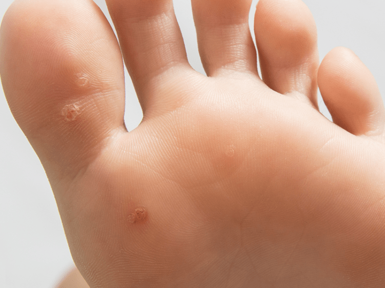 Verruca – Essex Nail Surgery and Foot Centre