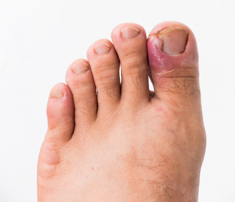 Ingrown Toenail – Essex Nail Surgery and Foot Centre