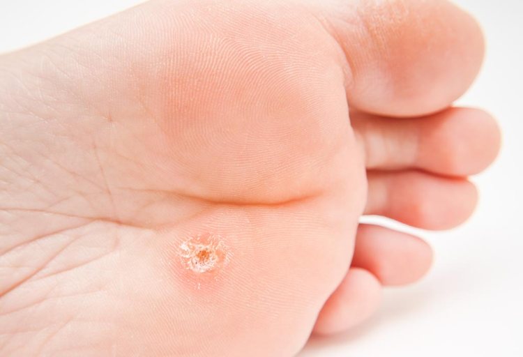Corns – Essex Nail Surgery and Foot Centre